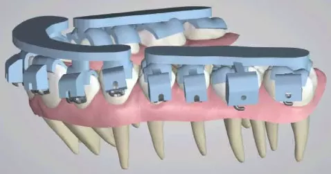 Orthodontic Progress Over Perfection | Ormco Supply